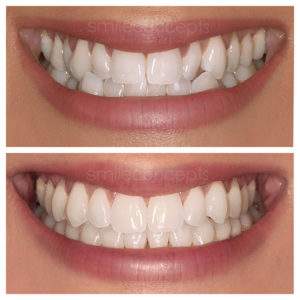 What are Ceramic Invisible Braces | Clear Braces Orthodontics Sydney