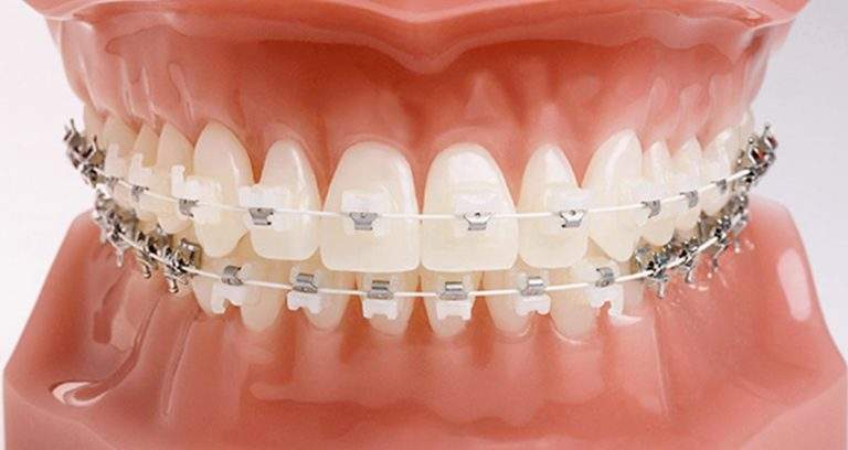 Maintain Smile with Retainers After Ceramic Braces in Sydney
