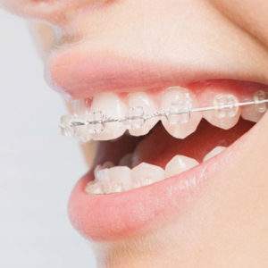 Clear Ceramic Braces, Orthodontics Braces, Sydney Orthodontics